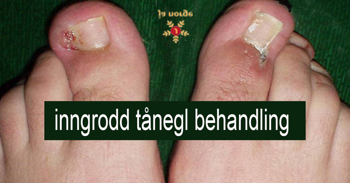 Inngrodd Tånegl Behandling: Tips og råd